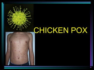 Measles, Mumps, Rubella, Chicken pox | PPT