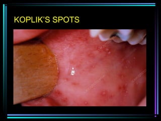 Measles, Mumps, Rubella, Chicken pox | PPT