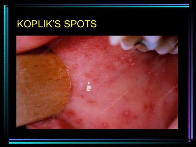 Measles, Mumps, Rubella, Chicken pox