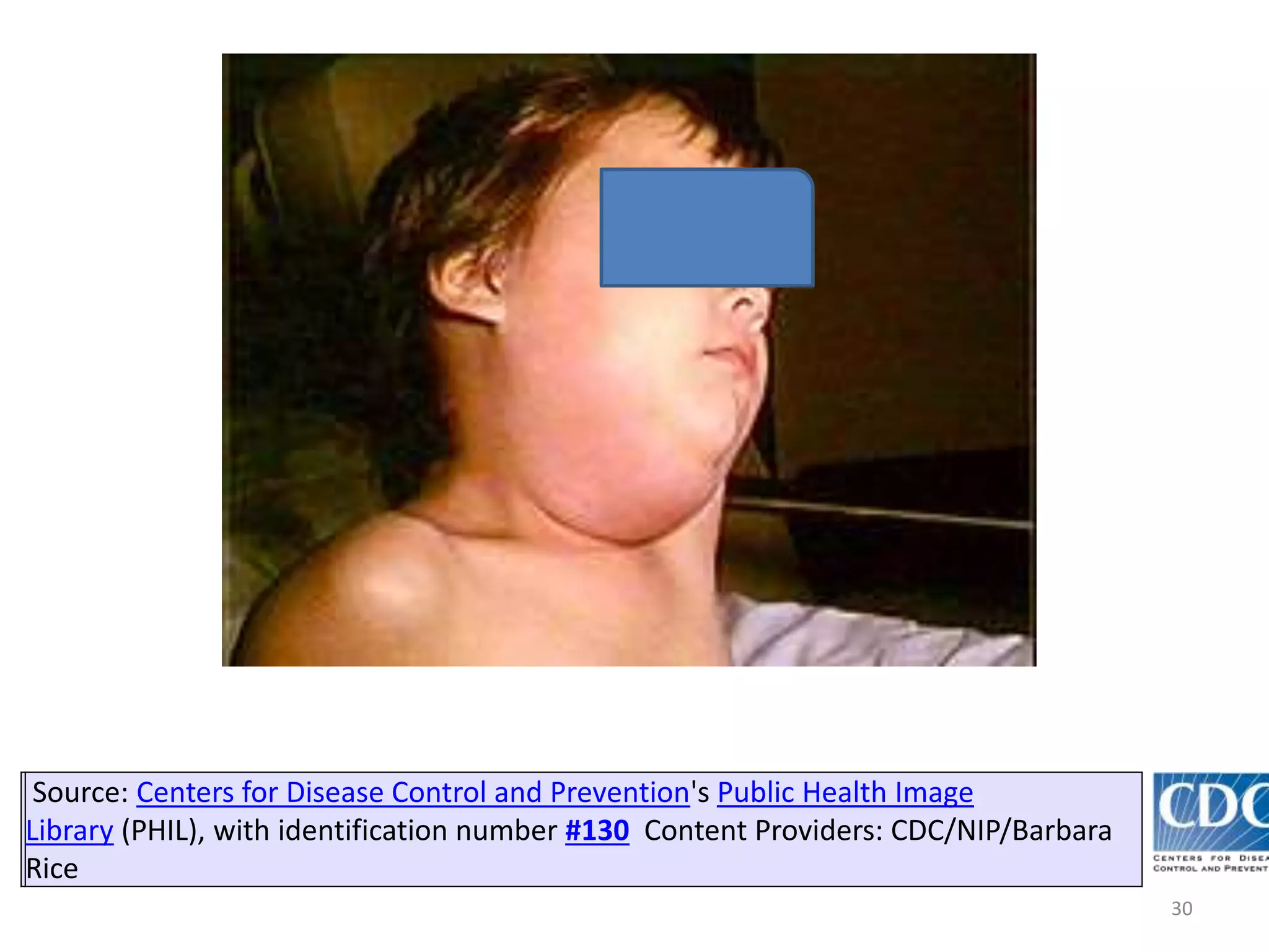 MEASLES, MUMPS & RUBELLA | PPTX