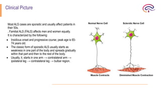 Motor neuron diseases | PPTX