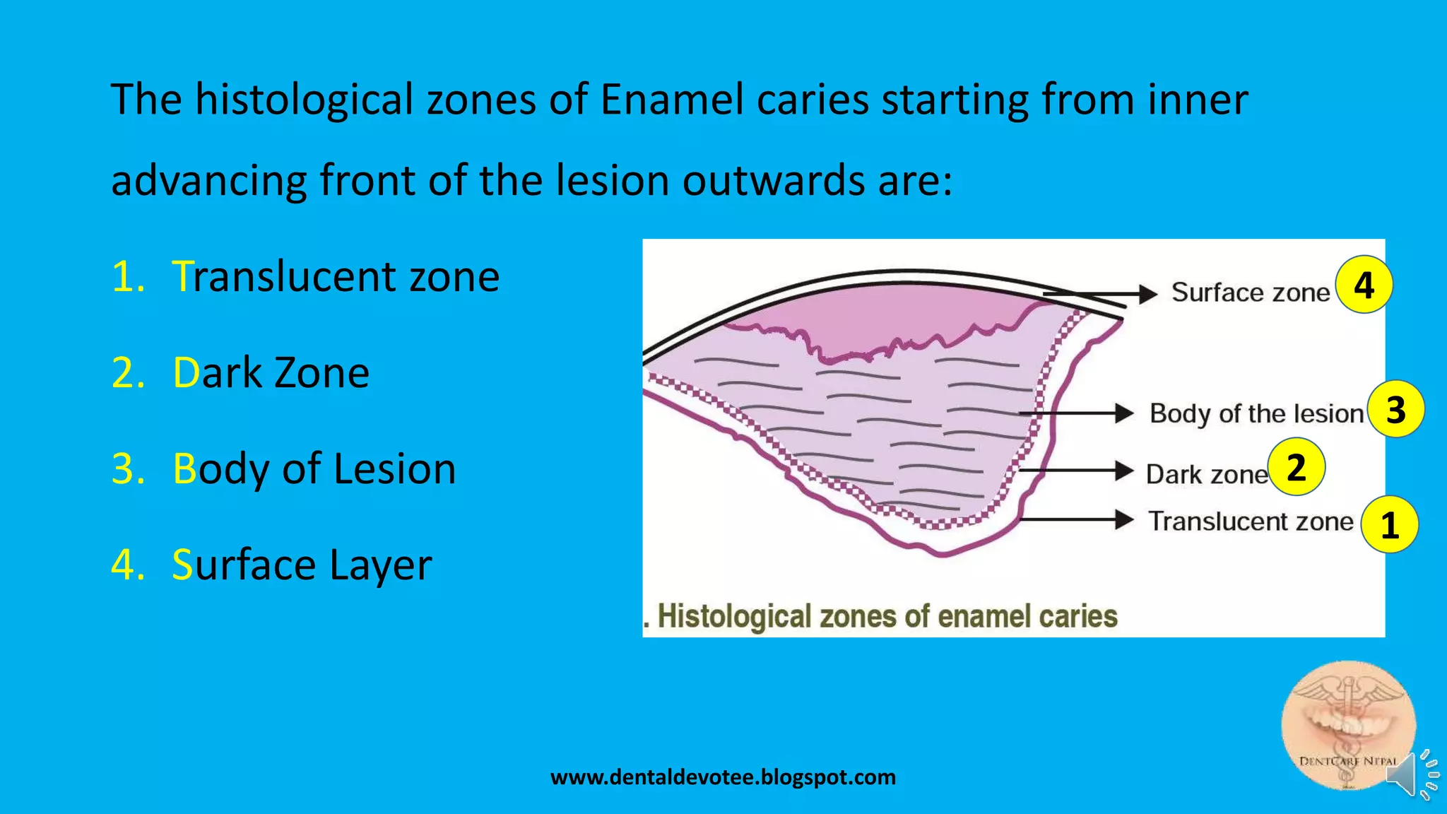 Mnemonics : Histological zones of enamel and dentinal caries | PPTX