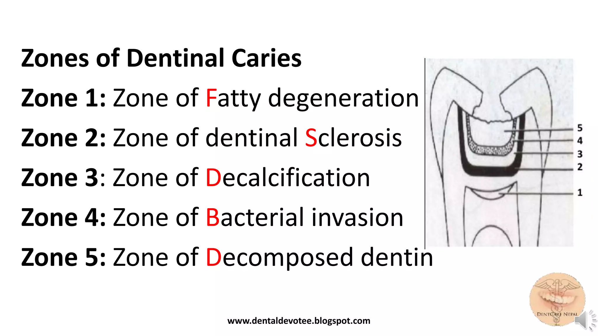 Mnemonics : Histological zones of enamel and dentinal caries | PPTX