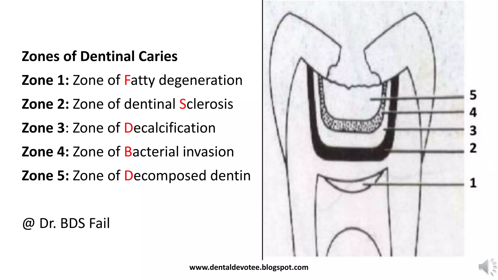 Mnemonics : Histological zones of enamel and dentinal caries | PPTX