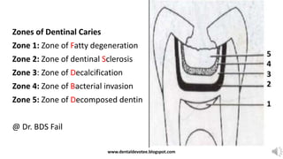 Mnemonics : Histological zones of enamel and dentinal caries | PPT