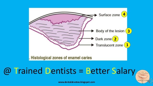 Mnemonics : Histological zones of enamel and dentinal caries