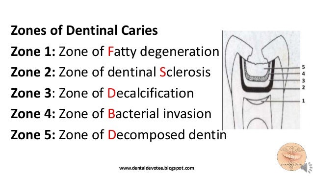 Mnemonics Histological Zones Of Enamel And Dentinal Caries