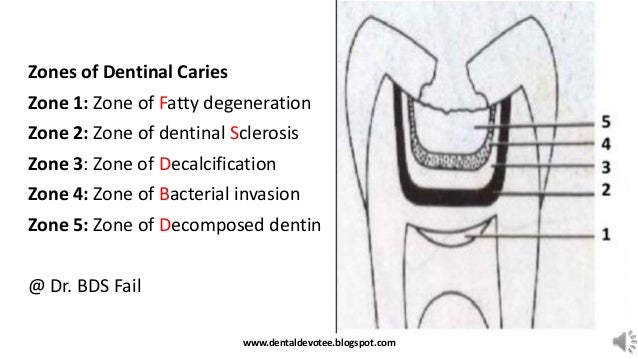 Mnemonics : Histological zones of enamel and dentinal caries
