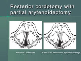 management of b/l vocal cord paralysis | PPT