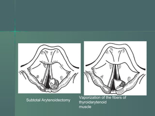 management of b/l vocal cord paralysis | PPT