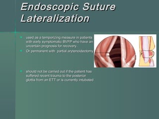 management of b/l vocal cord paralysis | PPT