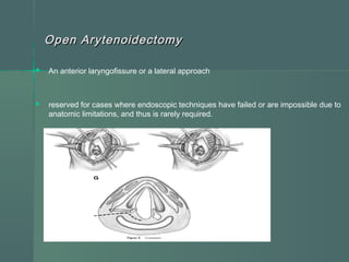 management of b/l vocal cord paralysis | PPT