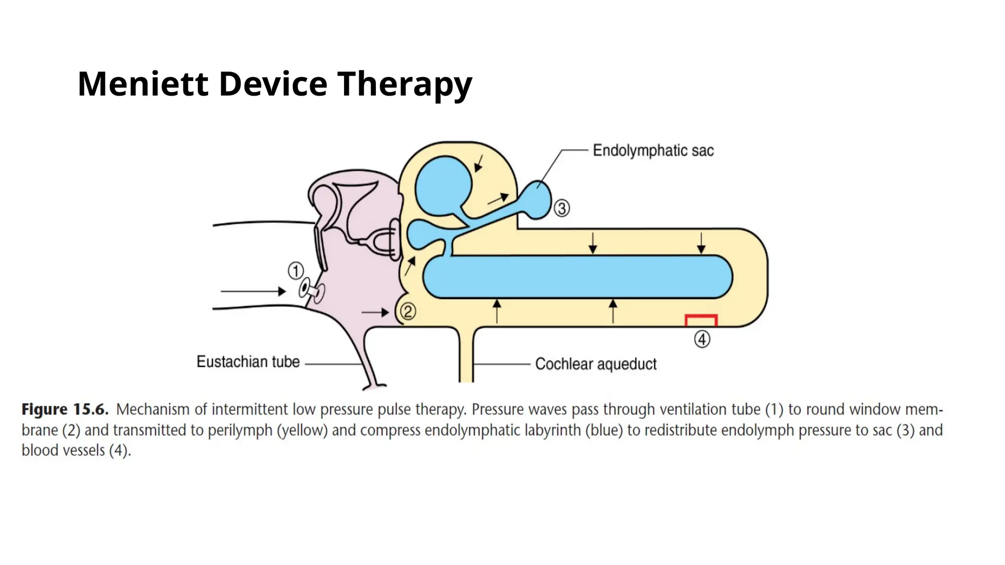 MÉNIÈRE’S DISEASE fhgfcbcbxvcfxfdxbgfhgfbv | PPT