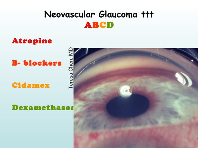 Mnemonics of Ophthalmology | PPT