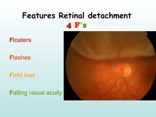 Mnemonics of Ophthalmology | PPT