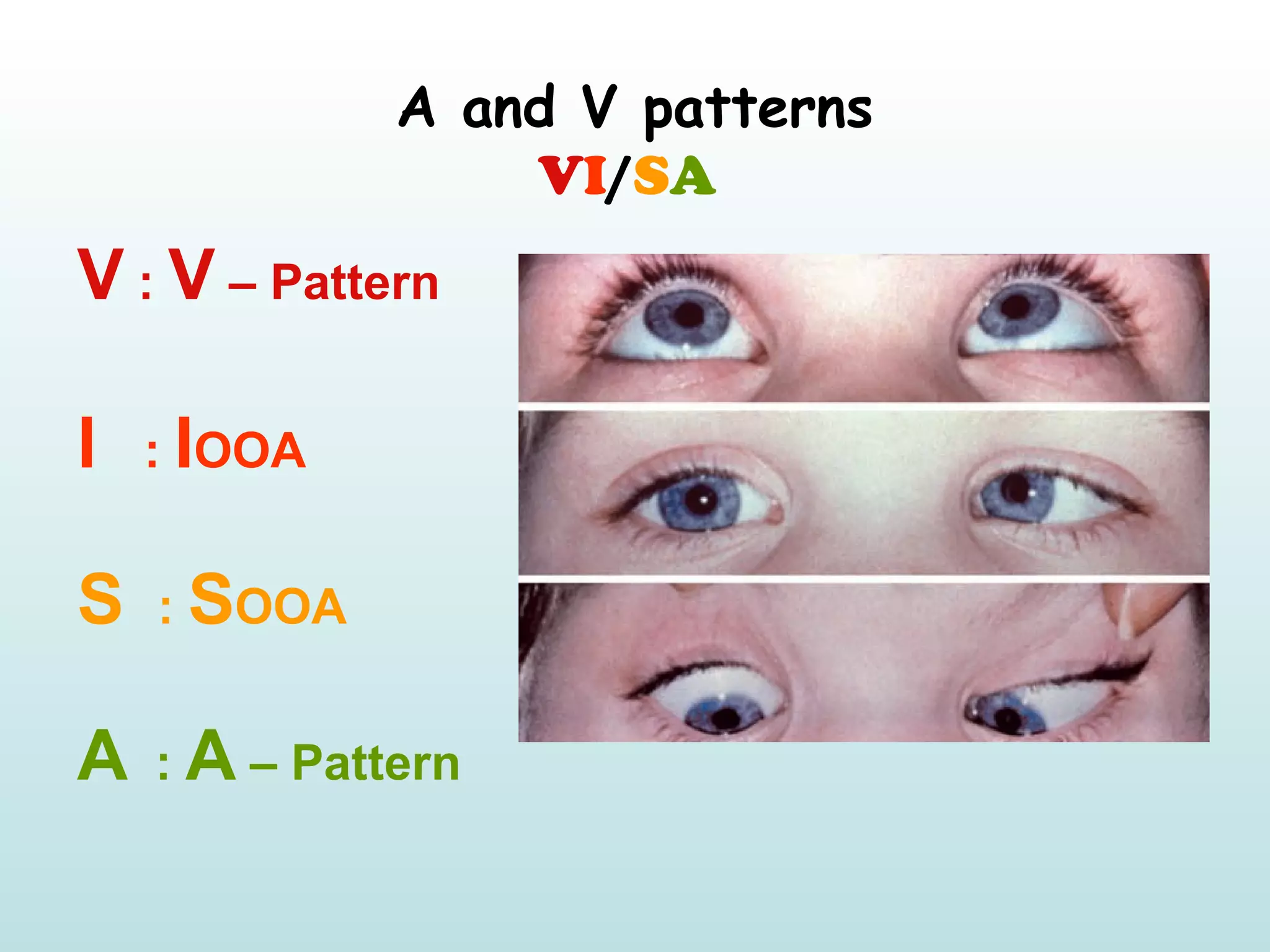 Mnemonics of Ophthalmology II | PPT