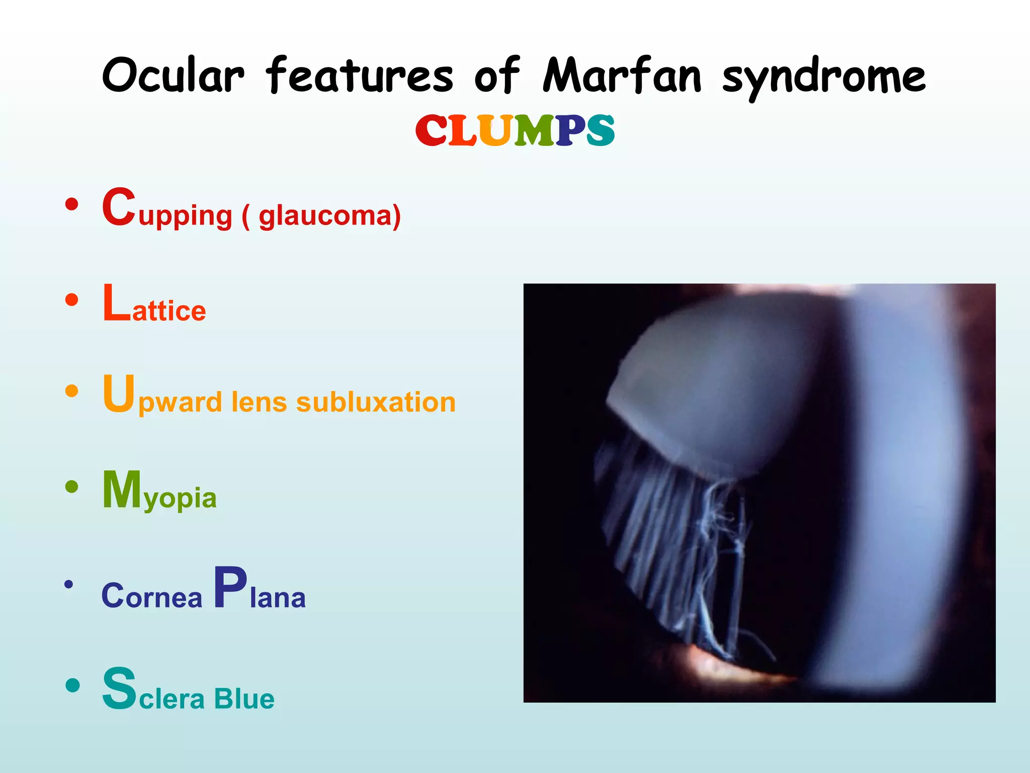 Mnemonics of Ophthalmology II | PPT