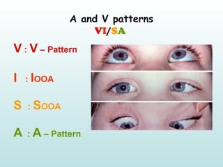 Mnemonics of Ophthalmology II | PPT