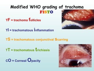 Mnemonics of Ophthalmology II | PPT