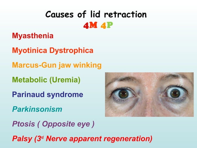 Mnemonics of Ophthalmology II | PPT | Eye and Vision Conditions ...