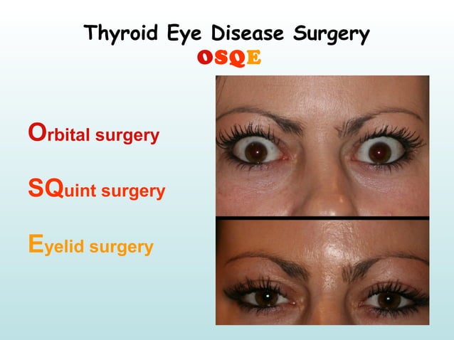 Mnemonics of Ophthalmology II | PPT | Eye and Vision Conditions ...