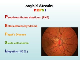Angioid Streaks Pepsi