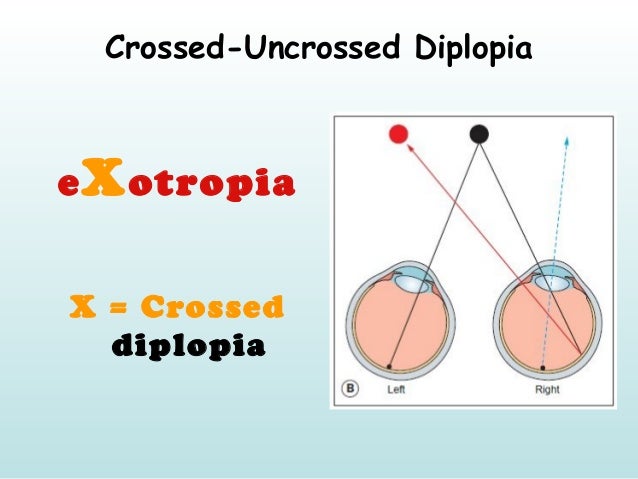 Mnemonics of Ophthalmology II