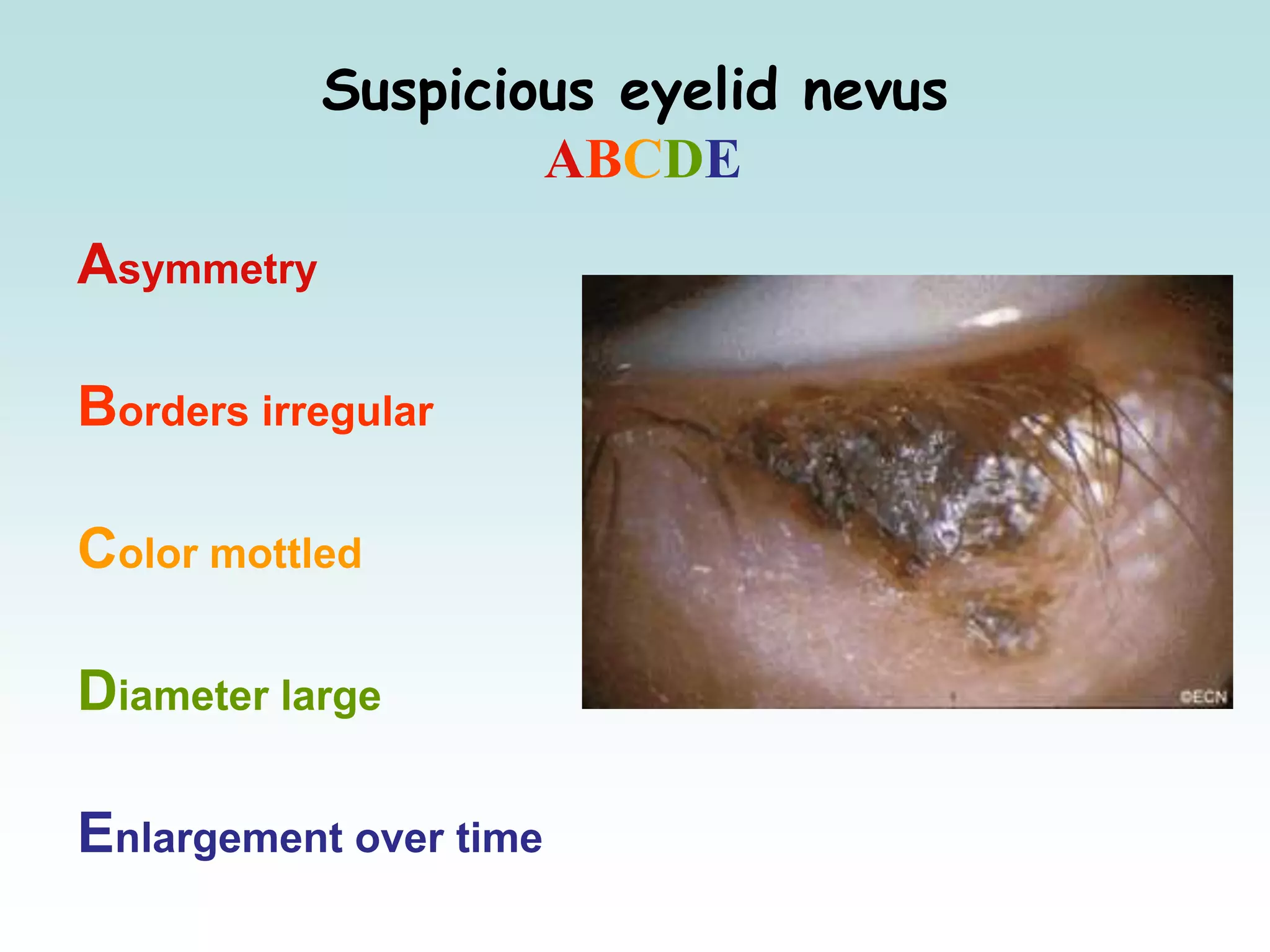 Mnemonics of Ophthalmology III | PPT