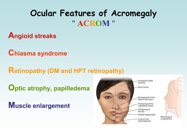 Mnemonics of Ophthalmology III | PPT