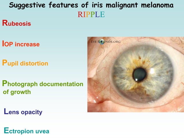 Mnemonics of Ophthalmology III | PPT