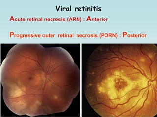 Mnemonics of Ophthalmology III | PPT