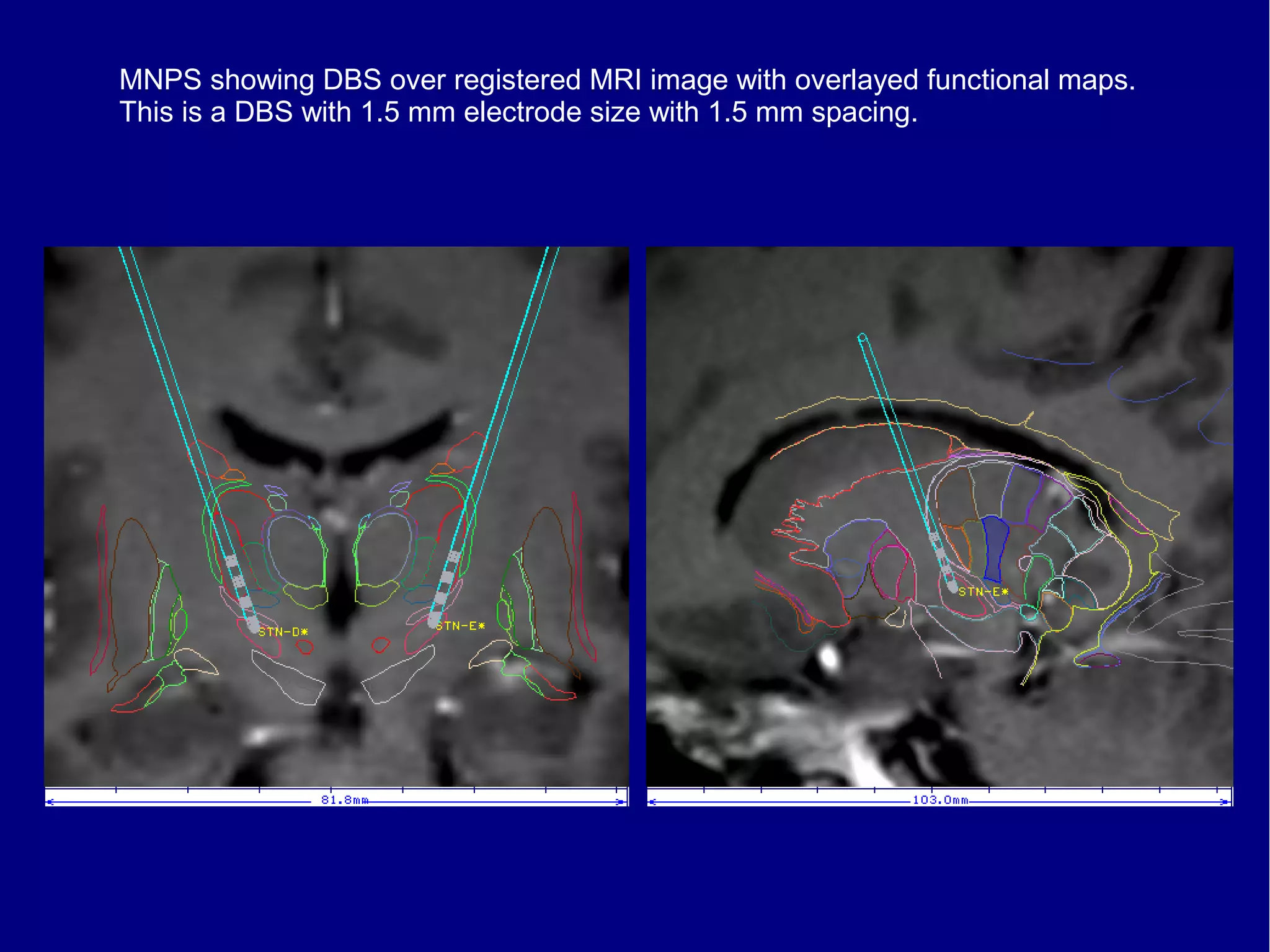 MNPS: Mevis Neurosurgery Planning System. Overview. | PDF