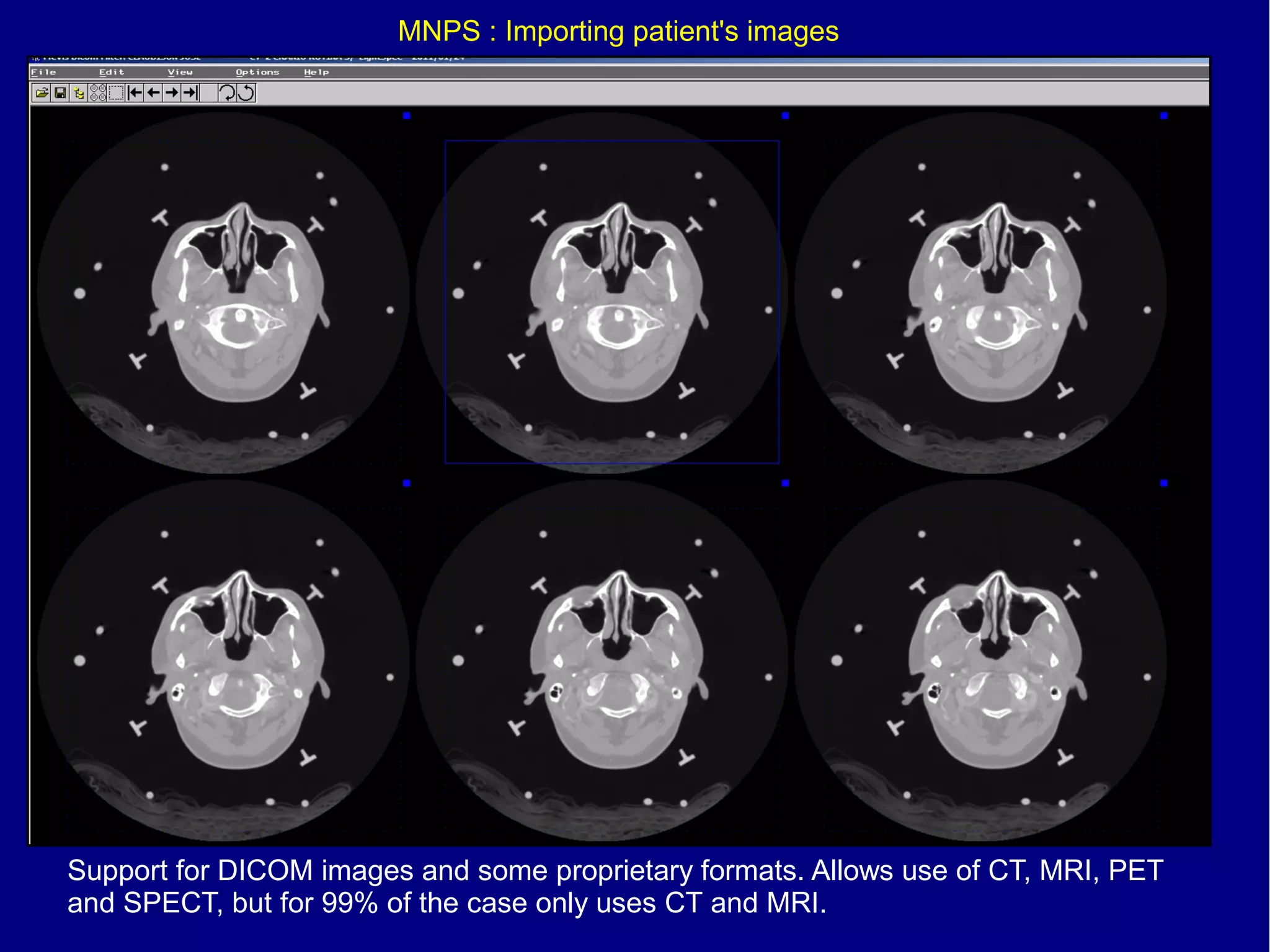 MNPS: Mevis Neurosurgery Planning System. Overview. | PDF