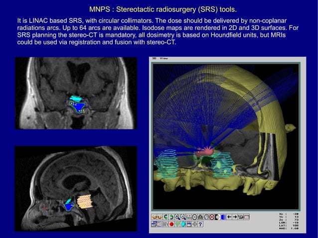 MNPS: Mevis Neurosurgery Planning System. Overview. | PPT