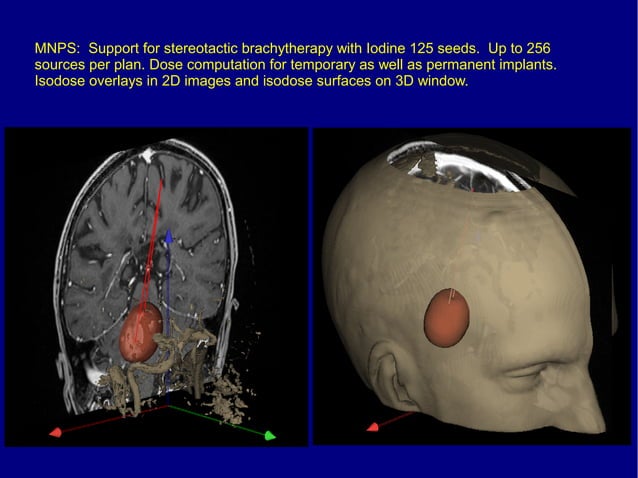MNPS: Mevis Neurosurgery Planning System. Overview. | PPT