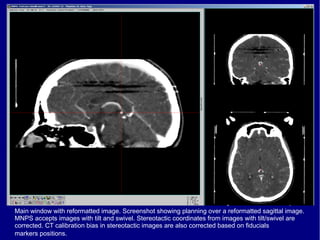 MNPS: Mevis Neurosurgery Planning System. Overview. | PDF