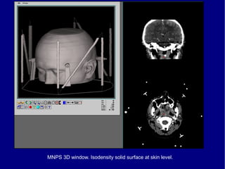 MNPS: Mevis Neurosurgery Planning System. Overview. | PDF