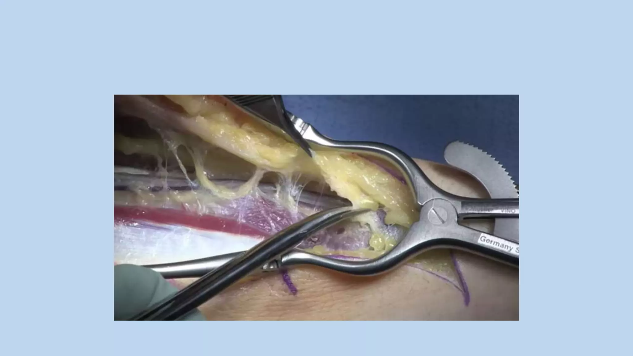 Median to Radial Nerve Transfers (FDS to ECRB, FCR to PIN) cadaveric ...
