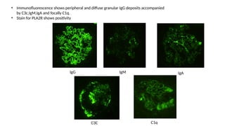 Adult onset nephro syndrome................ | PPT