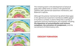 Adult onset nephro syndrome................ | PPT