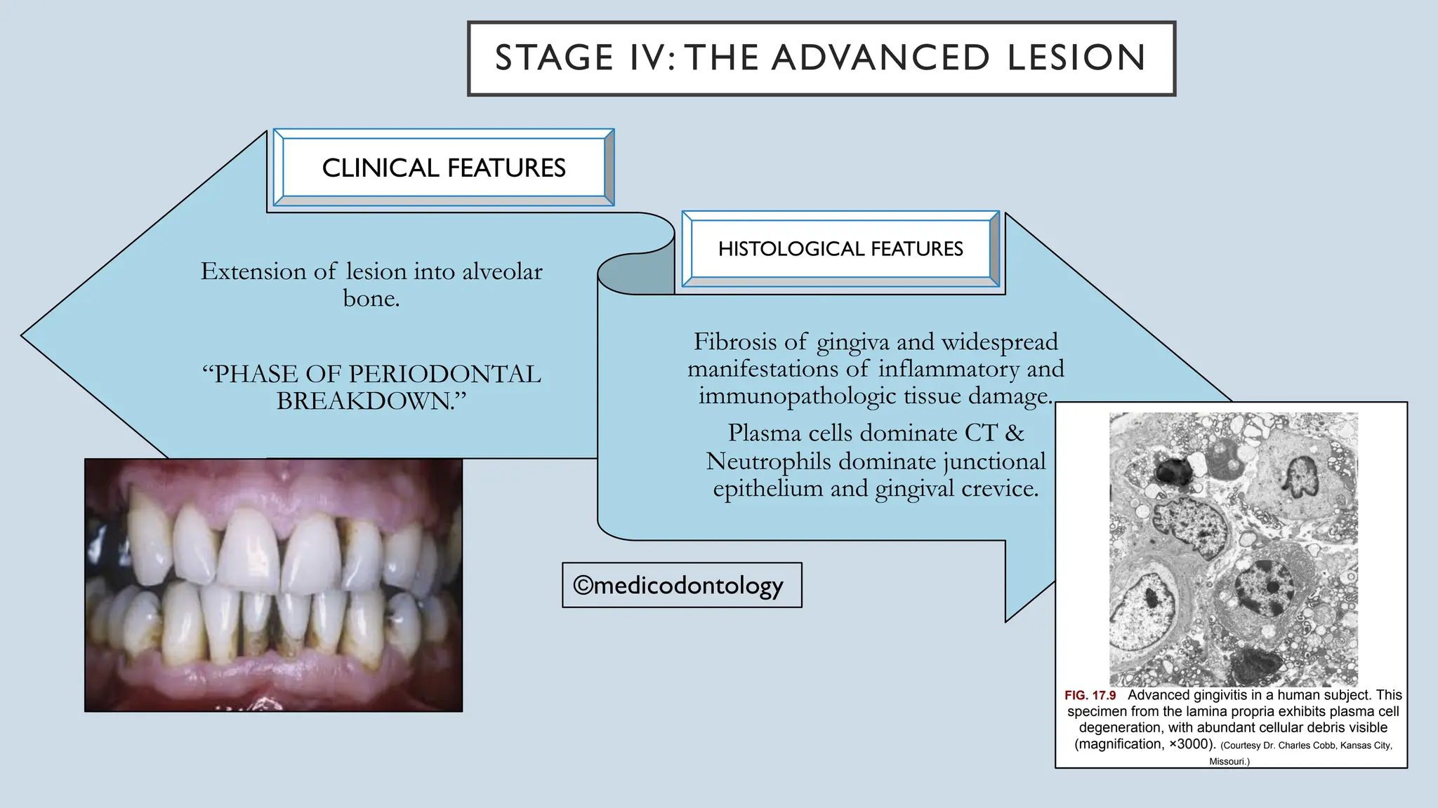 PERIODONTICS- GINGIVAL INFLAMMATION- | PDF