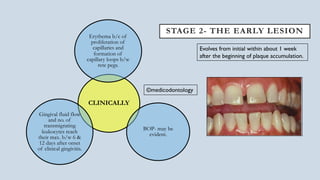 PERIODONTICS- GINGIVAL INFLAMMATION- | PDF