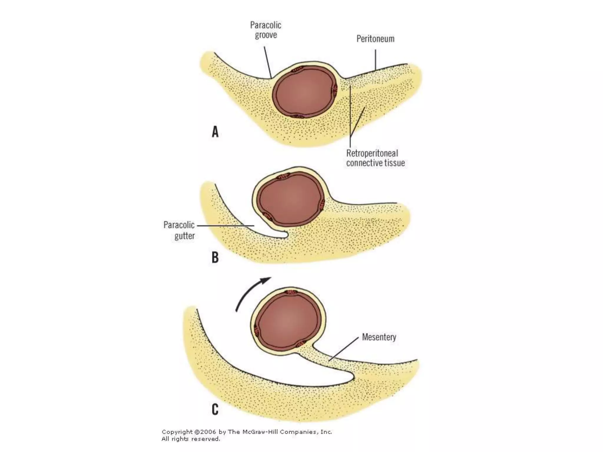 Mobile cecum syndrome | PPTX