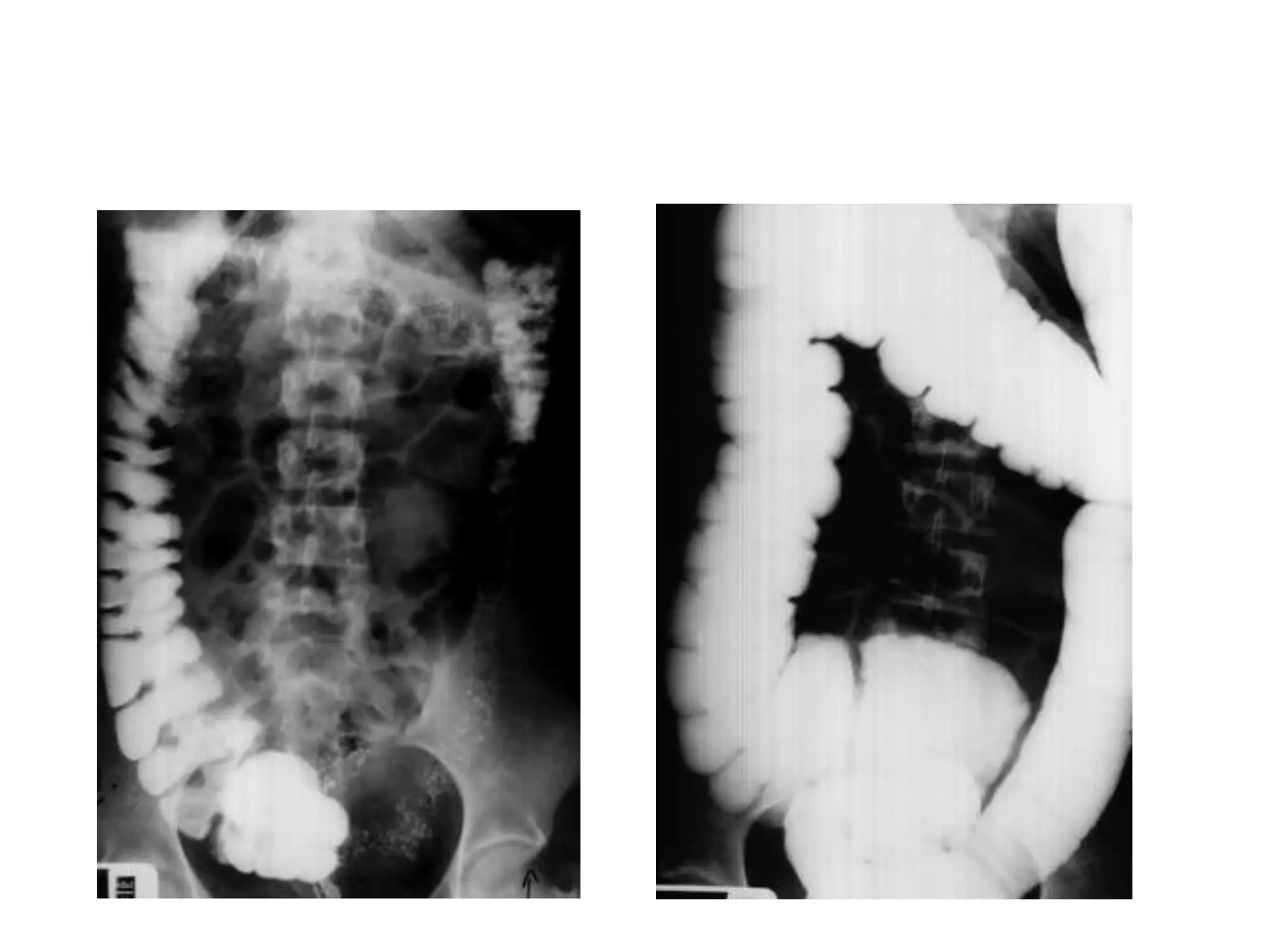 Mobile cecum syndrome | PPTX