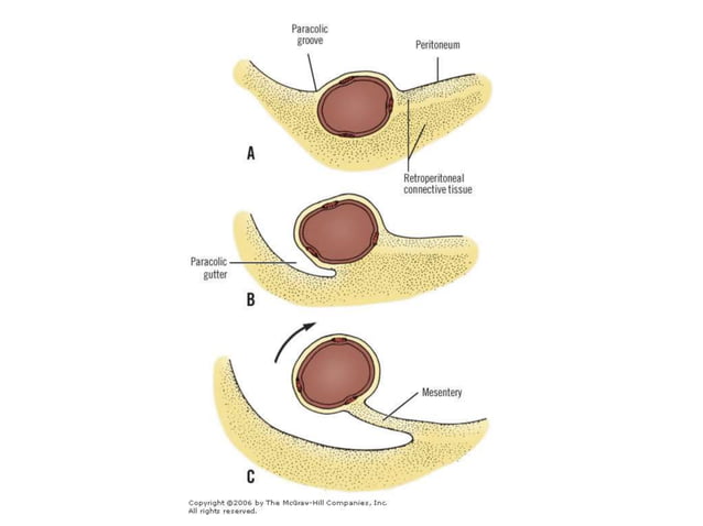 Mobile cecum syndrome | PPTX