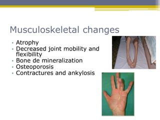 IMMOBILITY : NURSING MANAGEMENT | PPTX