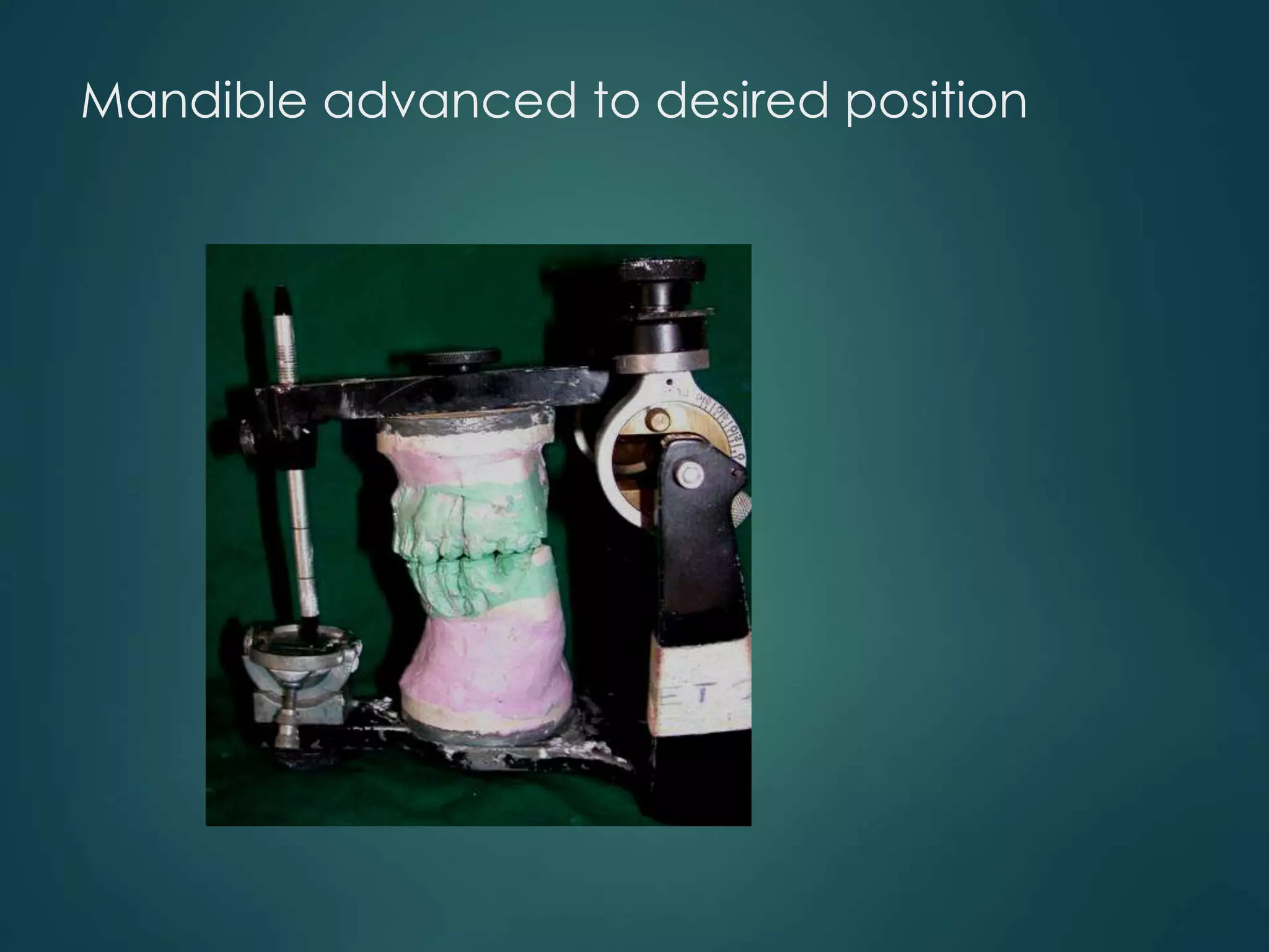 Mock surgery,softwares & advances orthognathic | PPTX