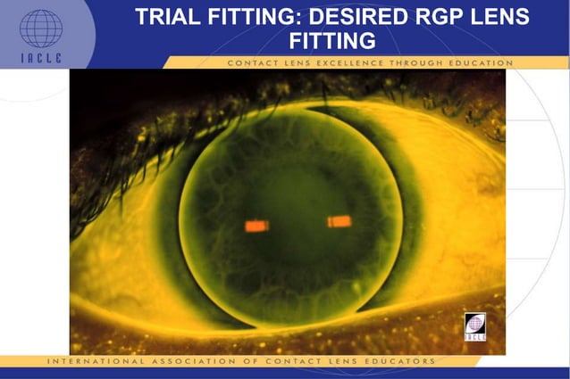 Introduction to Contact Lens Fitting_ Module 3.1 | PPTX