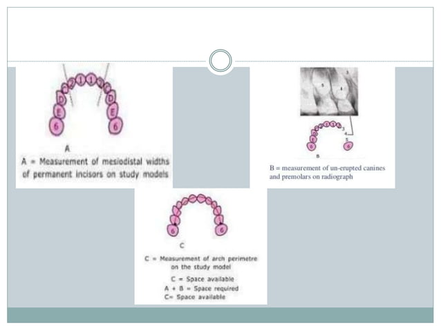 Model analysis in orthodontics | PPTX