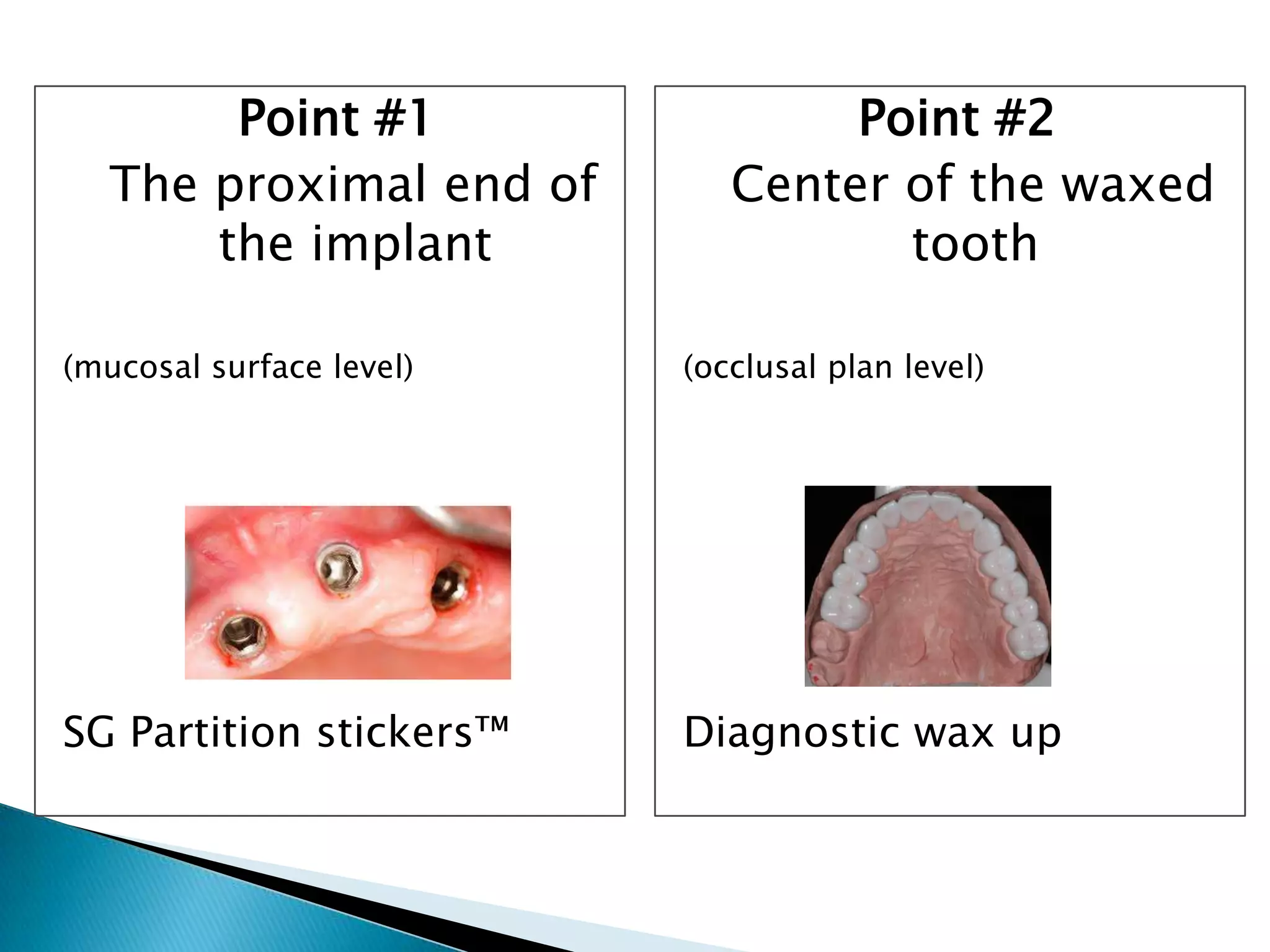 Implant treatment planning: Model base planning for implant fixed ...